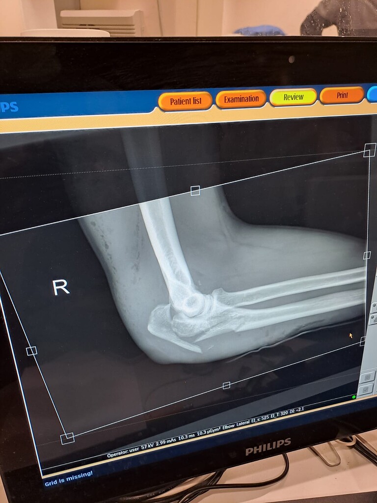 Elbow fracture question - Medical Q&A [Moderated] - Barbell Medicine Forum