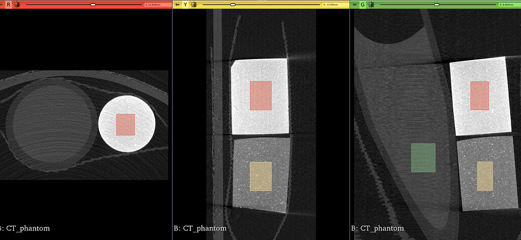 Bone Mineral Density (BMD) measurement method - Support - 3D Slicer ...