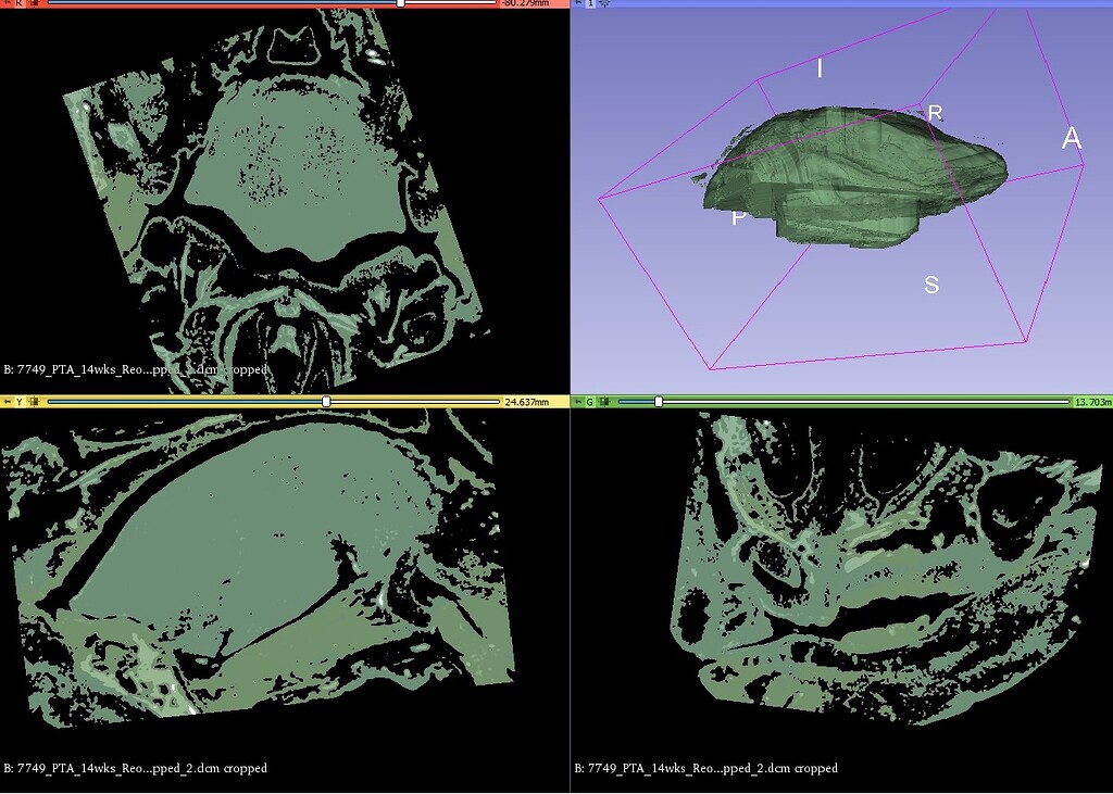 Trouble Segmenting The Tongue After Fixing Threshold Support 3d Slicer Community 9236