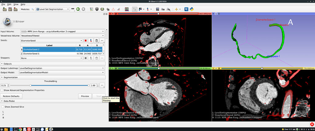 Slicer VMTK LevelSetSegmentation no Start - Support - 3D Slicer Community
