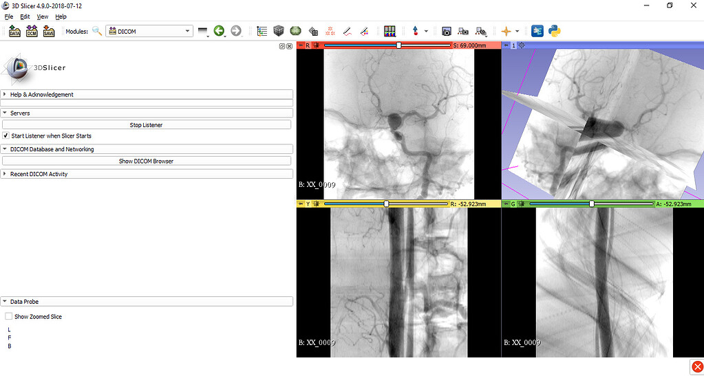 Problems creating a volume from rotational angiography data - Page 2 - Support - 3D Slicer Community
