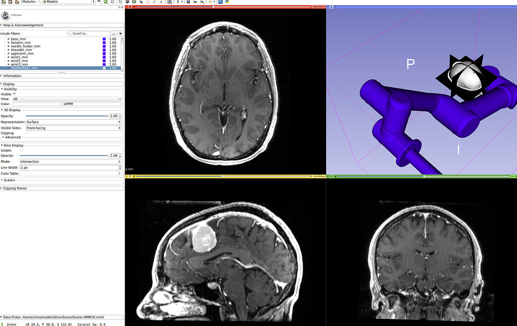 How do I get a model of a spine from DICOM files - Support - 3D Slicer ...