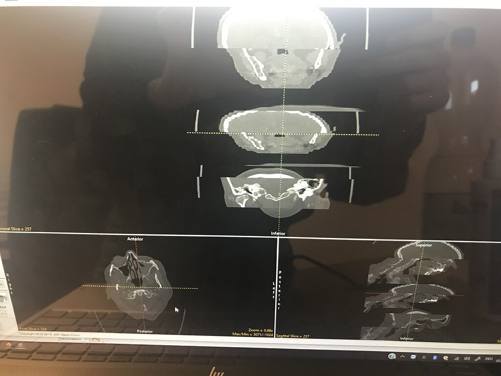 Segmentation Problem - Support - 3D Slicer Community