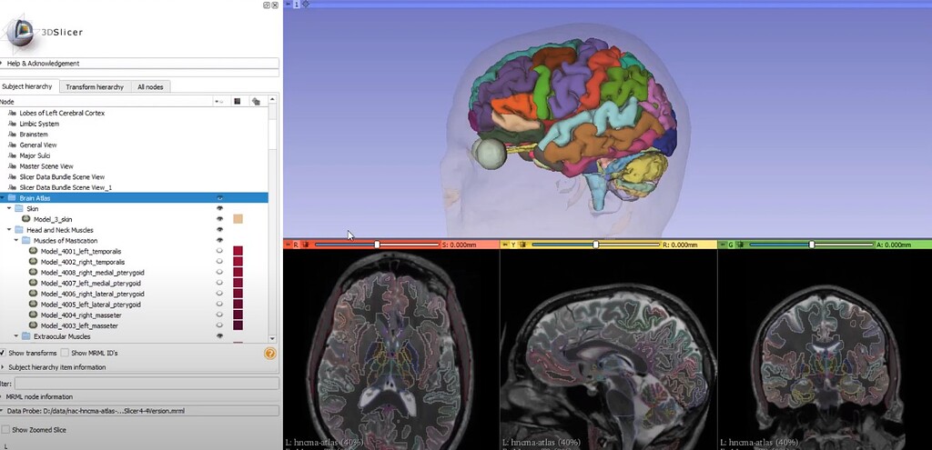 Anatomical brain segmentation - Support - 3D Slicer Community