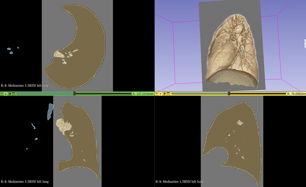 Volume Rendering - Lung Vessels segmentation without contrast - Support - 3D Slicer Community
