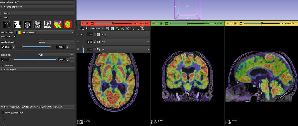 MRI PET fusion "add scalar volumes" new volume with color & opacity ...