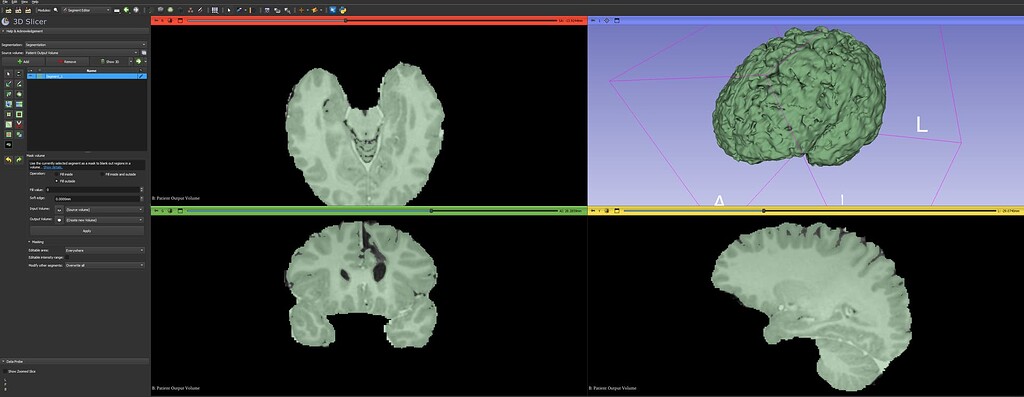 3d Brain modeling question from Flair MRI - Support - 3D Slicer Community