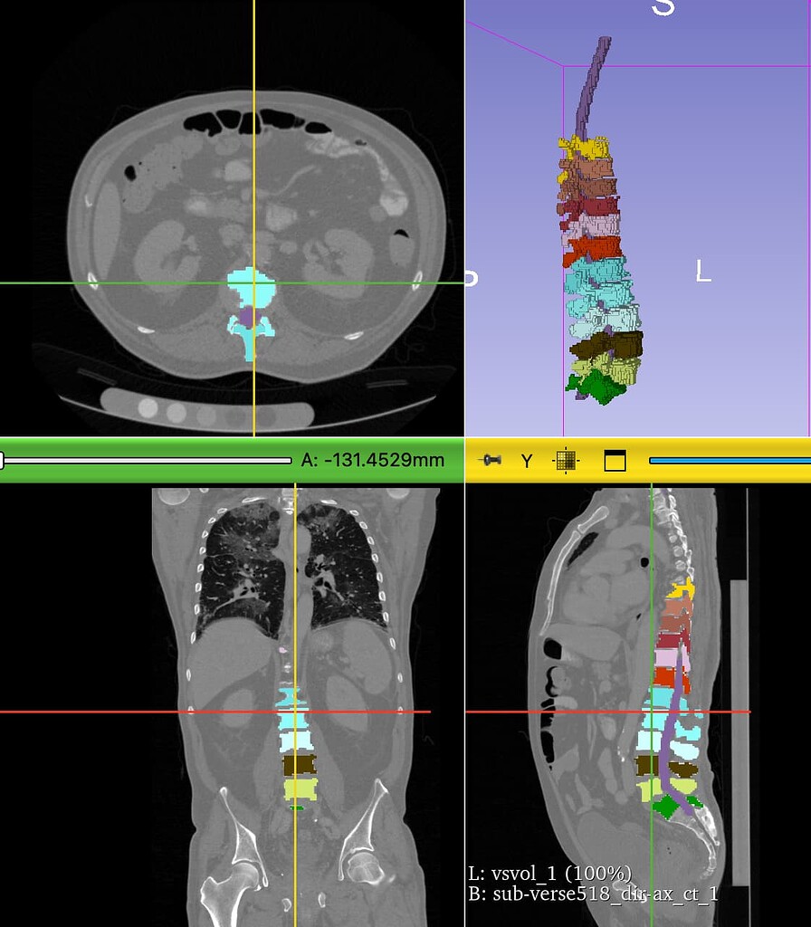 Howto `totalSegment` vertebrae_body with python? - Development - 3D ...