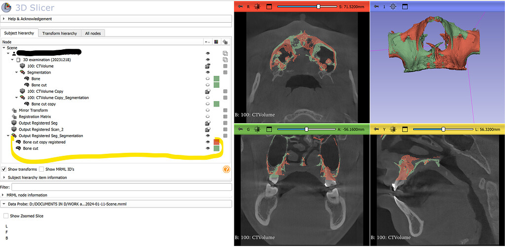 Problems In Subtracting 2 Segmentations Support 3d Slicer Community