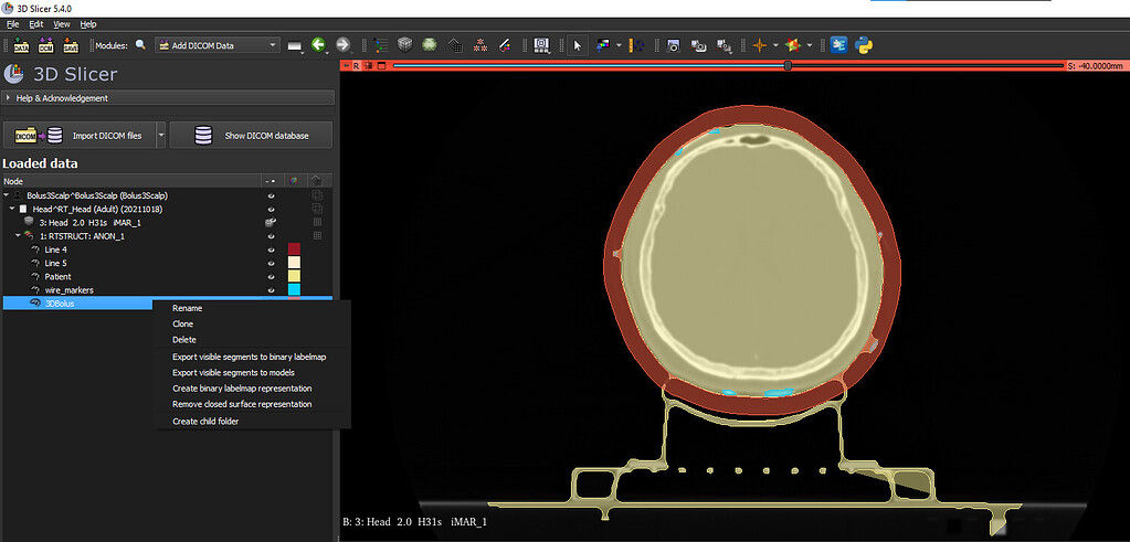 Exploring VTK-Based 3D Modeling of Floating-Point RTStruct Contours in 3D Slicer - Support - 3D ...