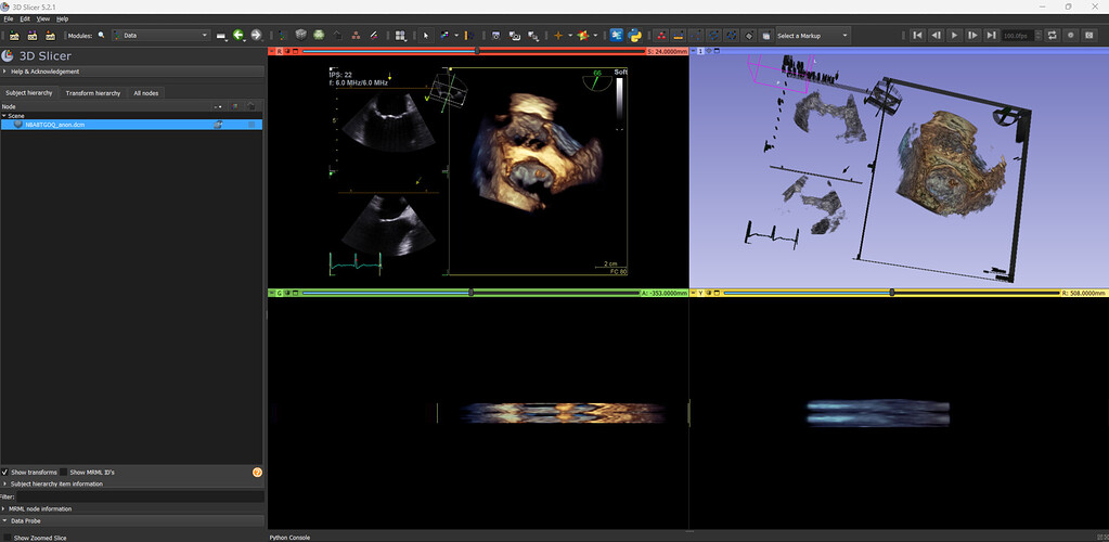 Mitral valve segmentation from Ge TEE Dicom - Support - 3D Slicer Community