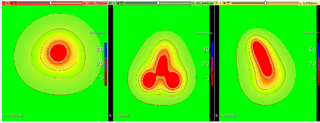 Calculating the volume encompassed by a given isodose - Support - 3D Slicer Community