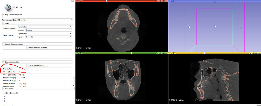 Segment comparison - DICE coefficient is wrong! - Support - 3D Slicer ...