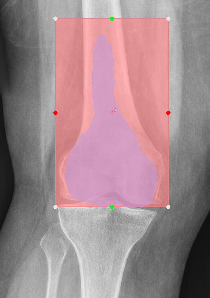 Extension For 2d X Ray Bone Segmentation Support 3d Slicer Community