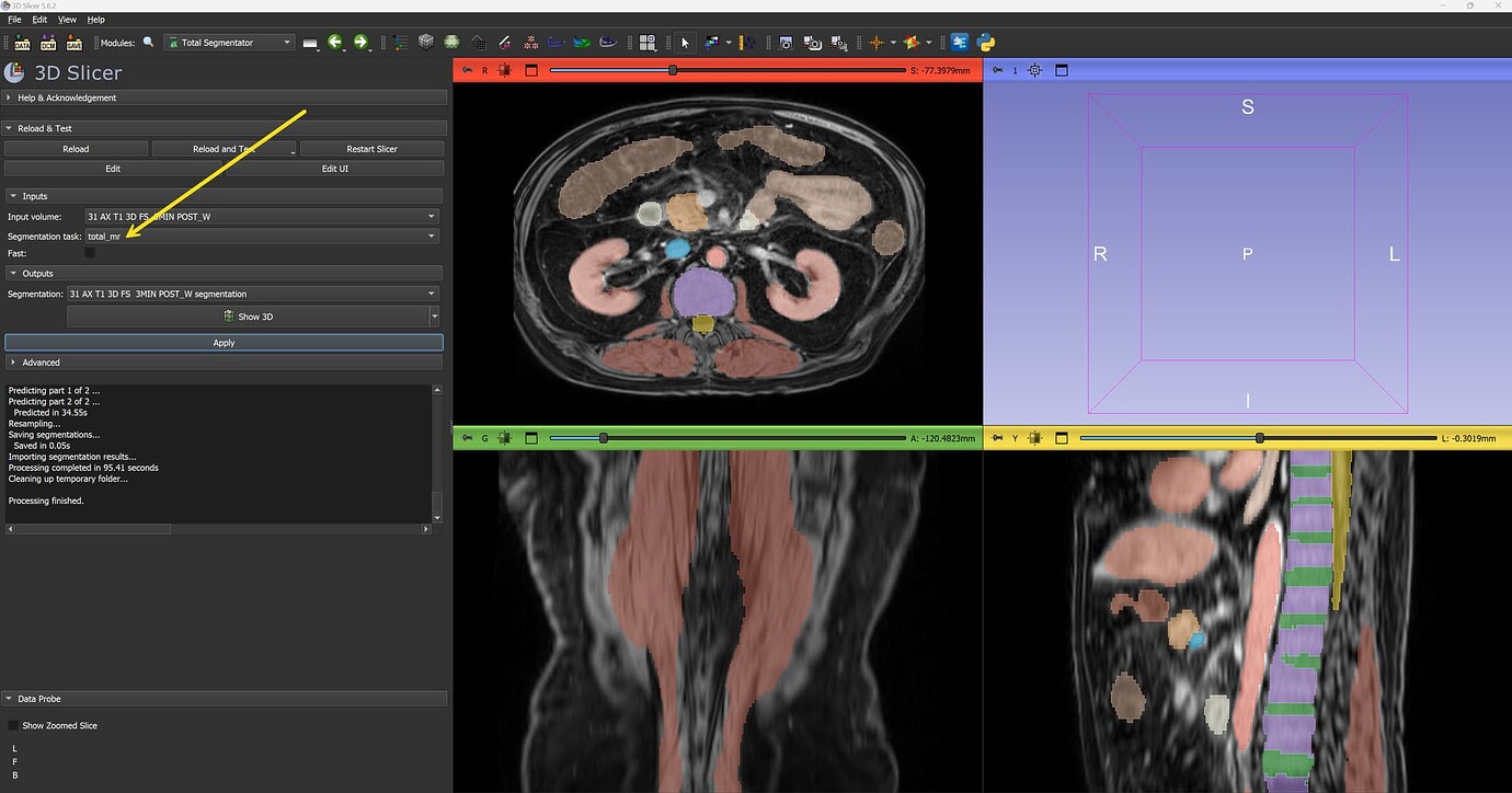 TotalSegmentator for MRI dataset - Support - 3D Slicer Community