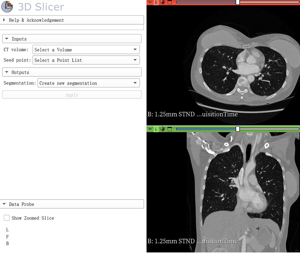 Airway segmentation can not select dicom volume - Support - 3D Slicer Community