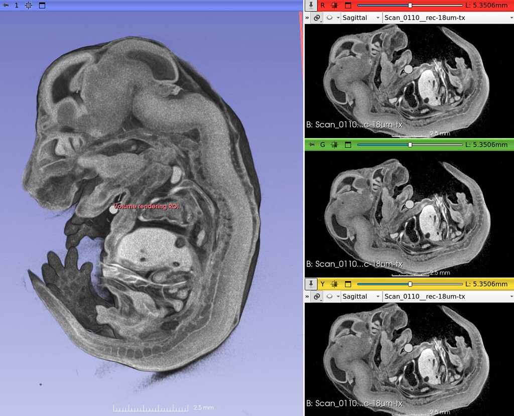 How to crop volume rendering by slices - Support - 3D Slicer Community