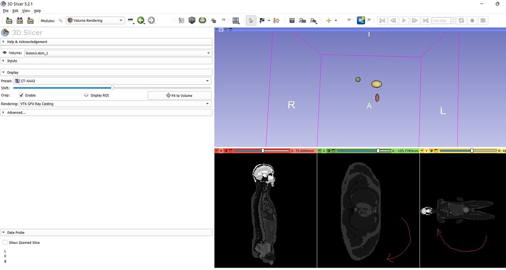 How to rotate the view of transaxially and sagittal plane? - Support - 3D Slicer Community