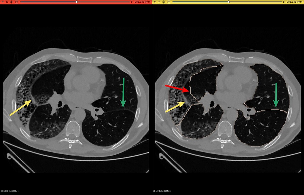 Improve Total Segmentator Lung Lobes Masks Support 3d Slicer Community