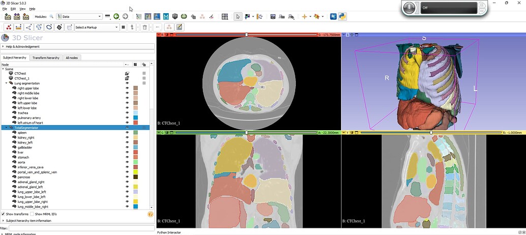 Lung CT Segmenter supports TotalSegmentator nnU-Net deep learning - Support - 3D Slicer Community
