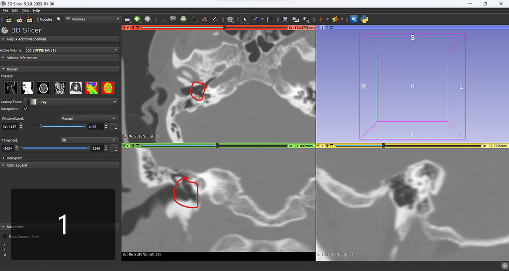 Segmentation of the tympanic membranes - Support - 3D Slicer Community