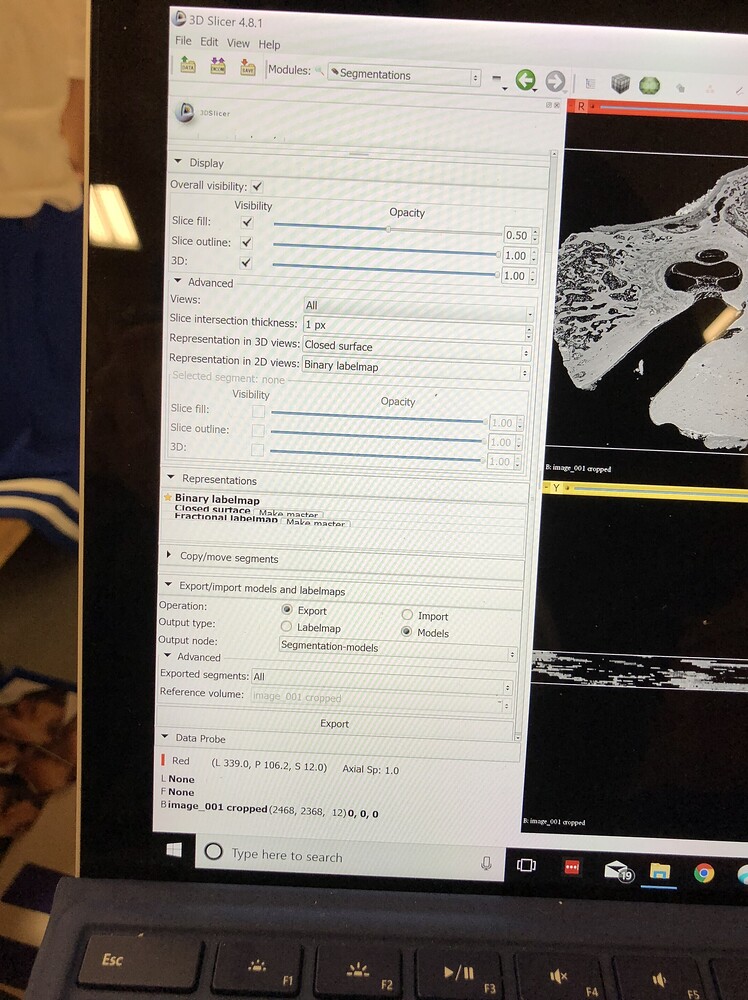 Create a 3D model from a series of DICOM images - Support - 3D Slicer ...