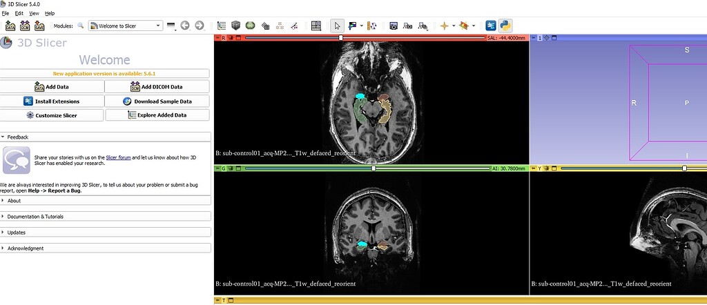 Segmentation Issue Invisible Labels Support 3d Slicer Community