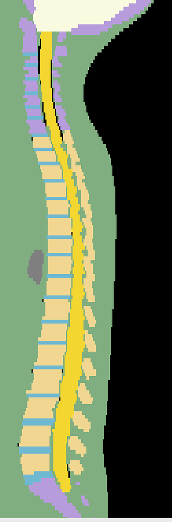 How can we fill air gaps - Support - 3D Slicer Community How can we fill air gaps - Support - 3D Slicer Community