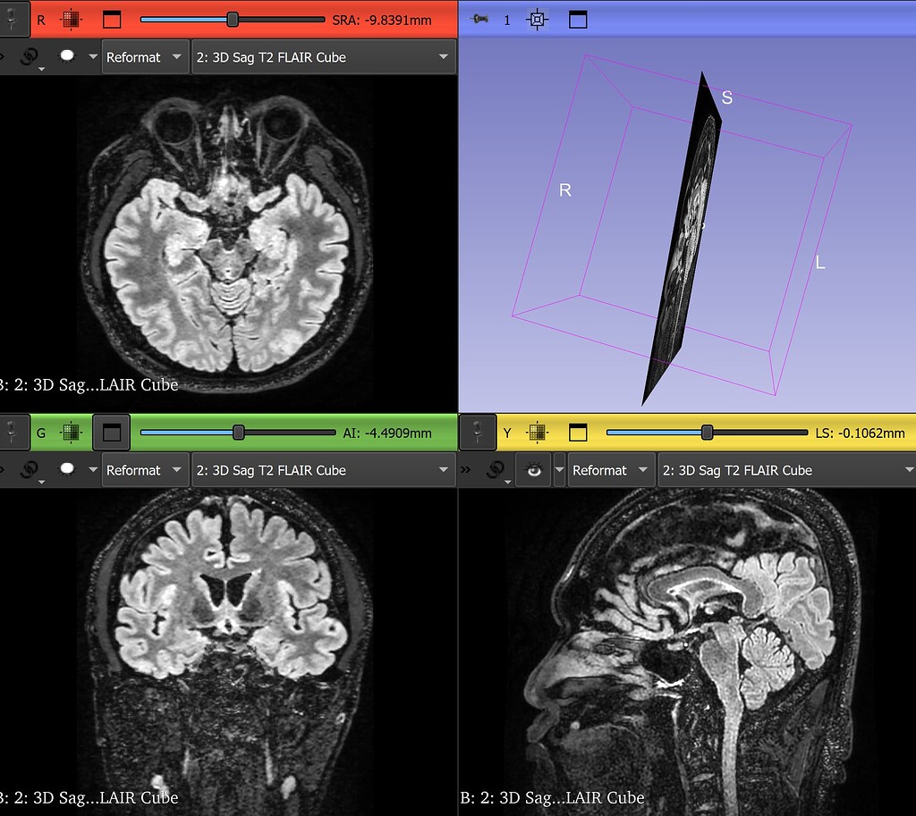 Automatically Generated Reformat Planes in 3D Slicer - Support - 3D Slicer Community