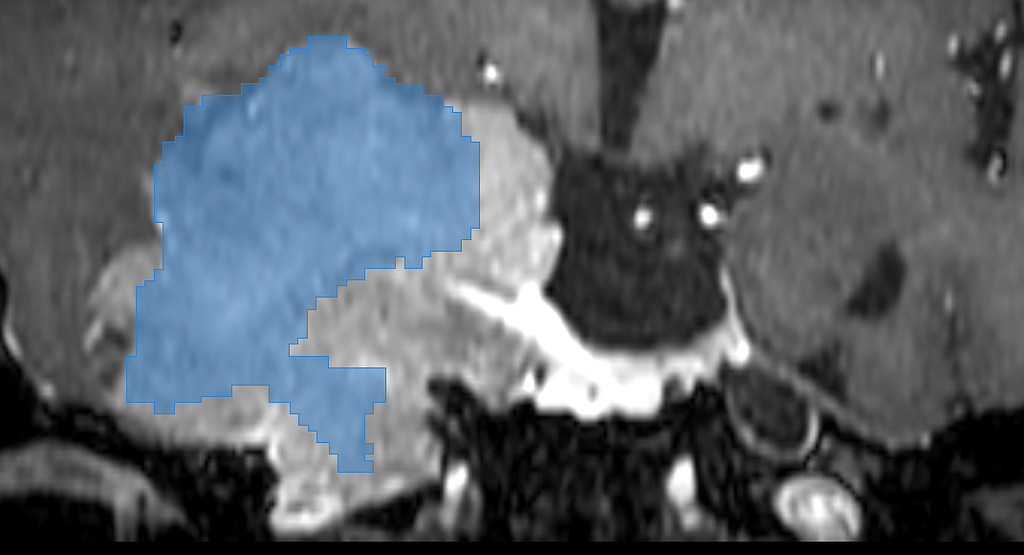 Do you know how to exactly extract brain tumor using NVIDIA module ...