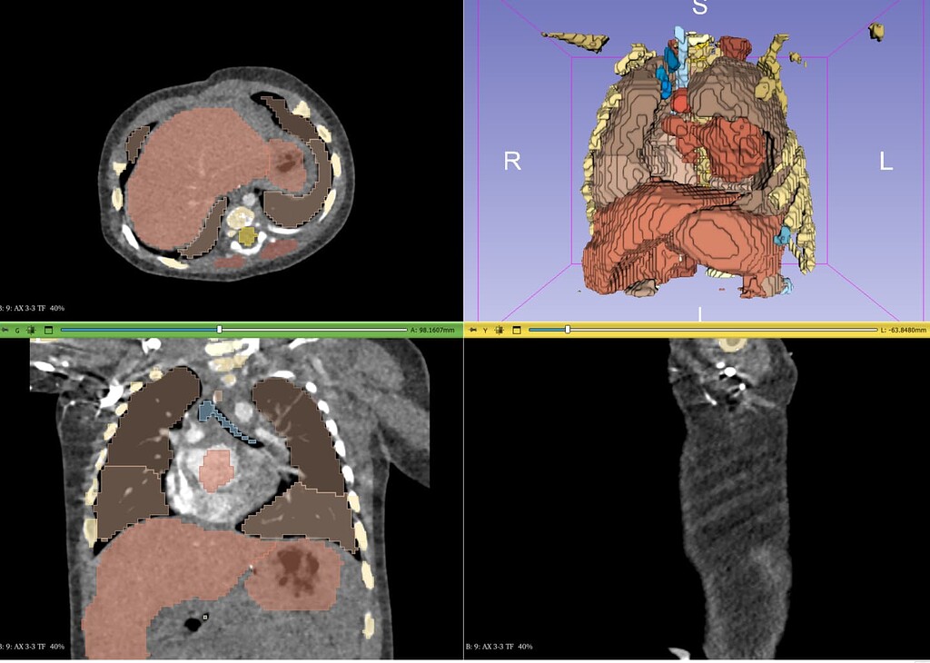 Totalsegmentator results look bricky - Support - 3D Slicer Community
