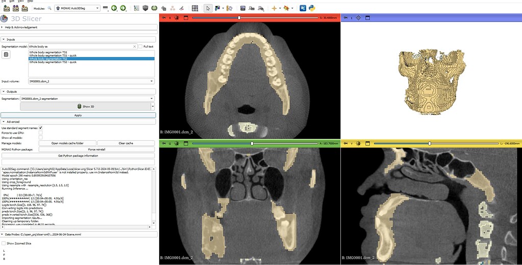 MONAI AutoSeg3D for CBCT (CMF) - Support - 3D Slicer Community