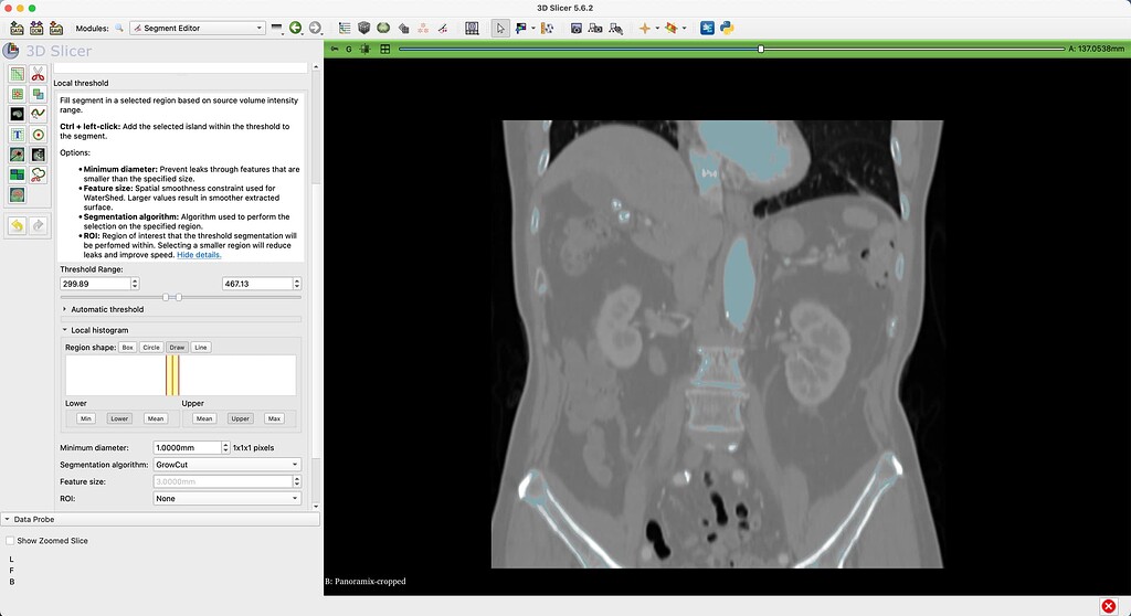 How to use local threshold - Feature requests - 3D Slicer Community