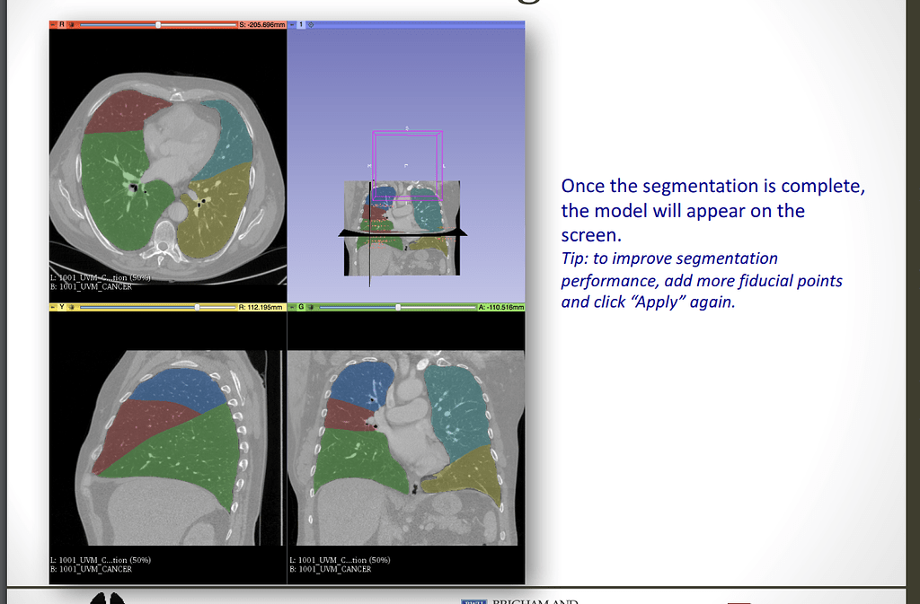 Interactive lobe segmentation problem - Support - 3D Slicer Community