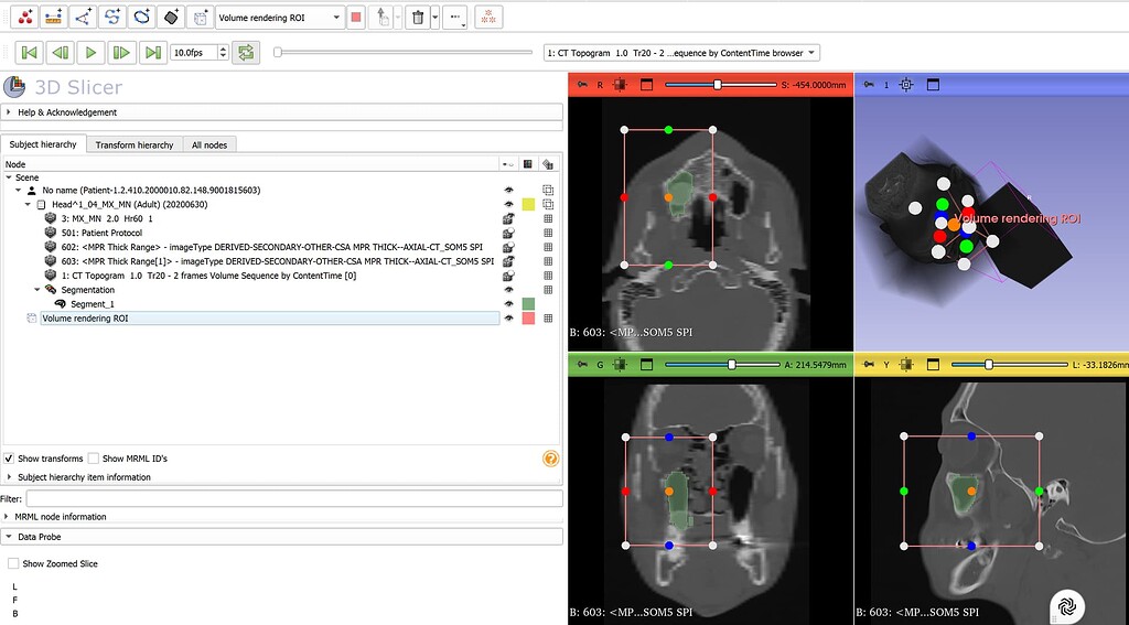Failed to create 3D model after segmentation in 3 planes - Support - 3D ...