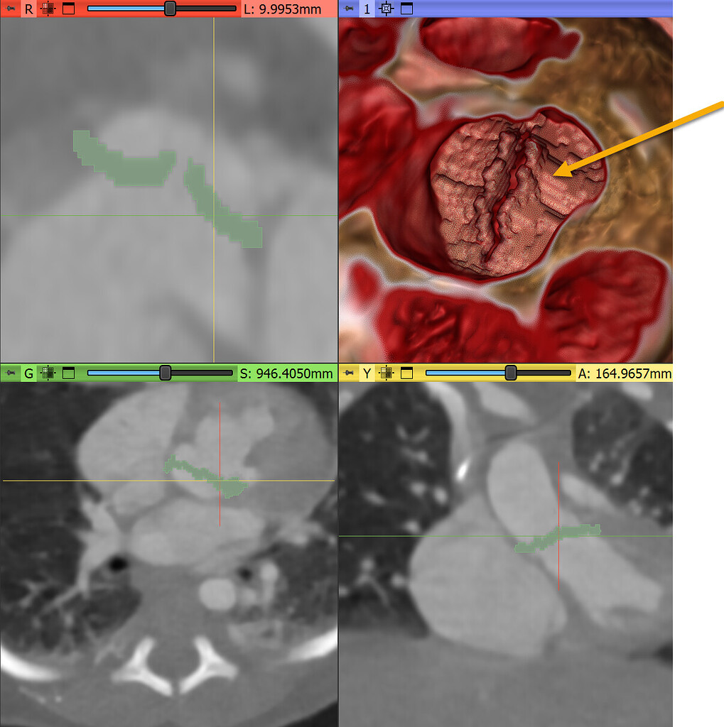New feature: Soft edge option in volume masking - Support - 3D Slicer ...