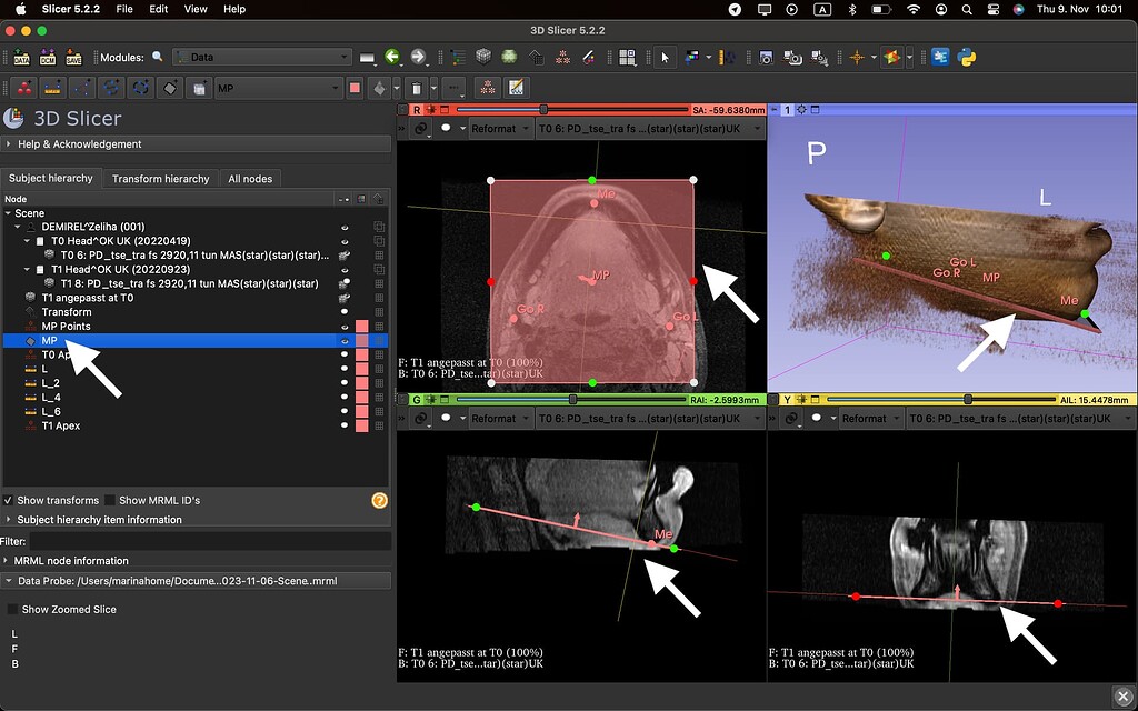 Create a new coordinate system for an MRI, based on a defined plane ...