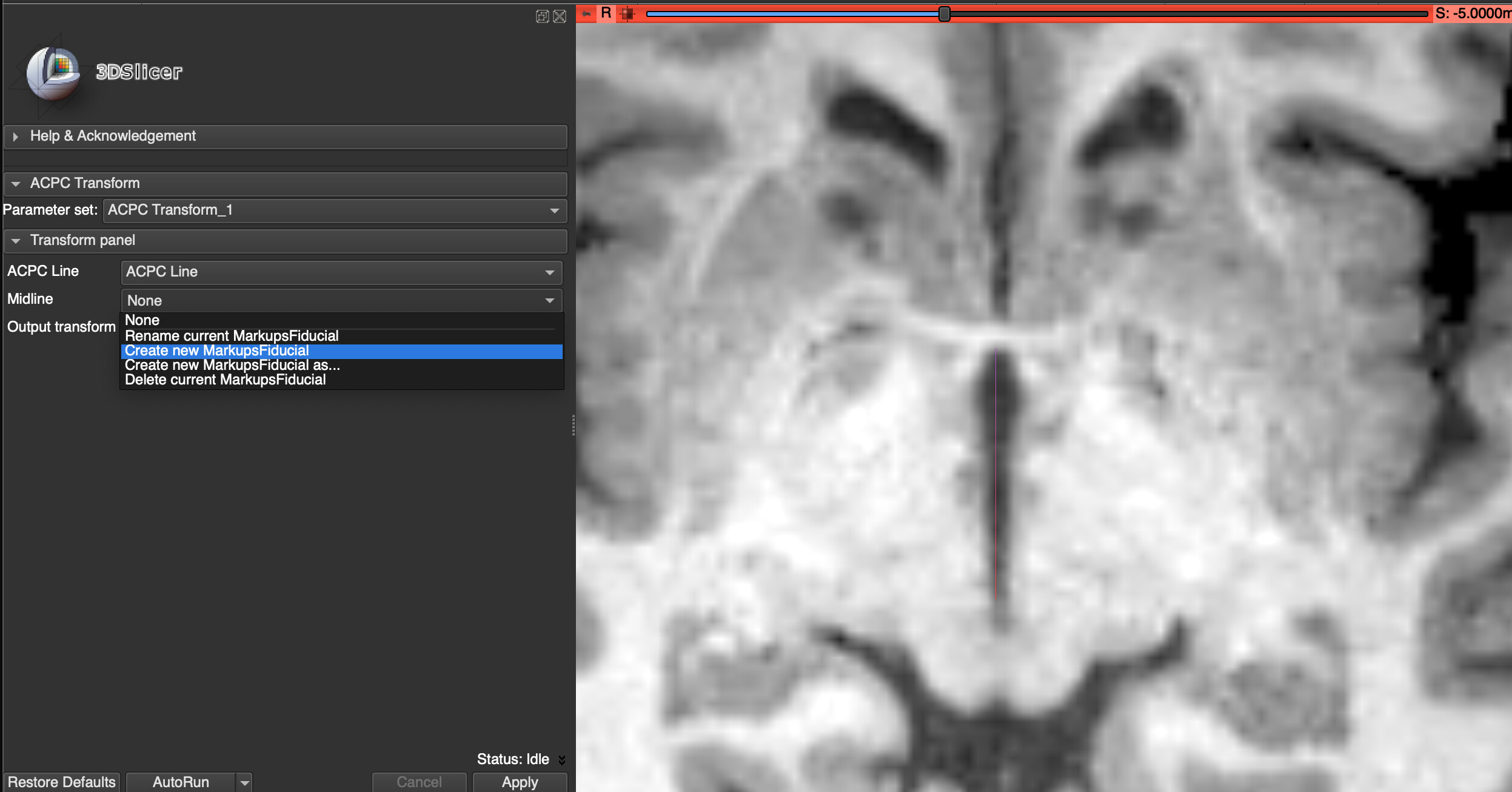ACPC Transform for MRI scans- Slicer 4.11 - Support - 3D Slicer Community