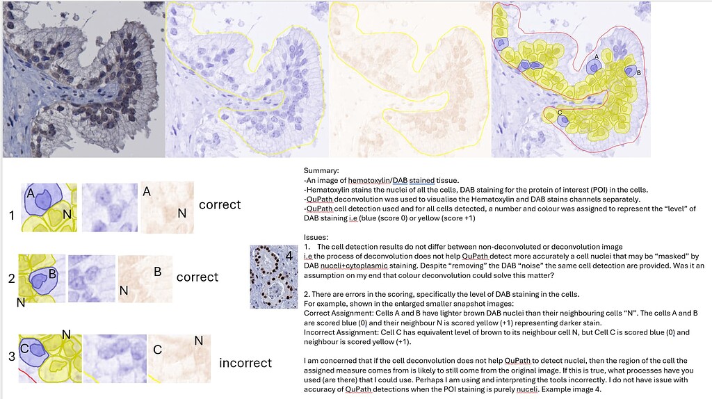 QuPath Detection and scoring of cells that have unclear nuclei due to DAB masking - Image ...