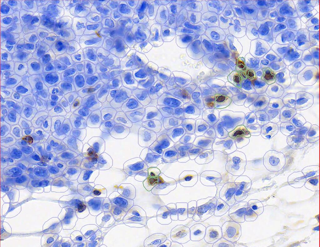 QuPath isn't counting all of my brown cells - Image Analysis - Image.sc Forum