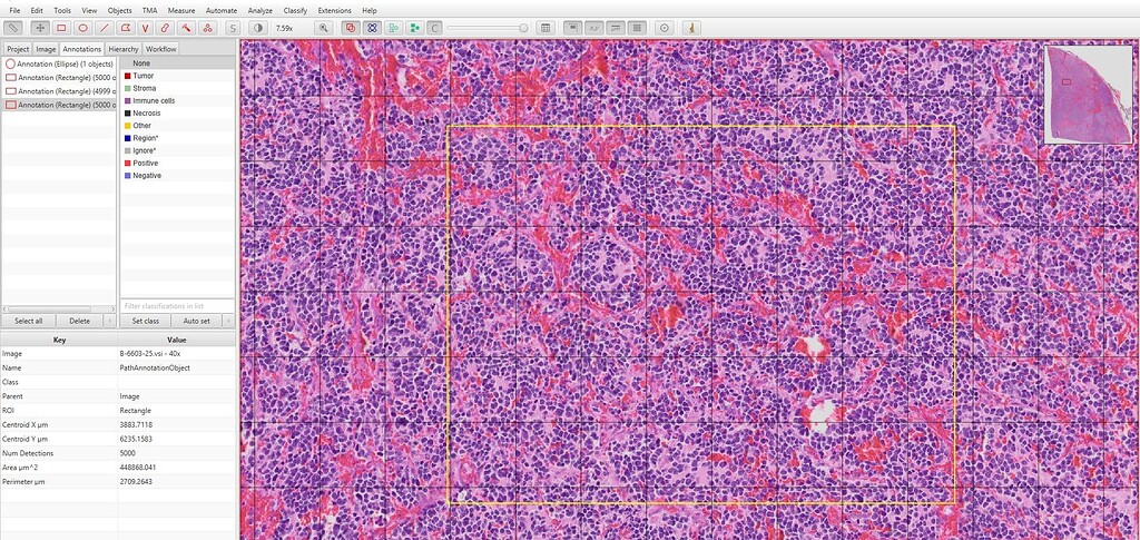 Neuroblastoma MKI - Image Analysis - Image.sc Forum