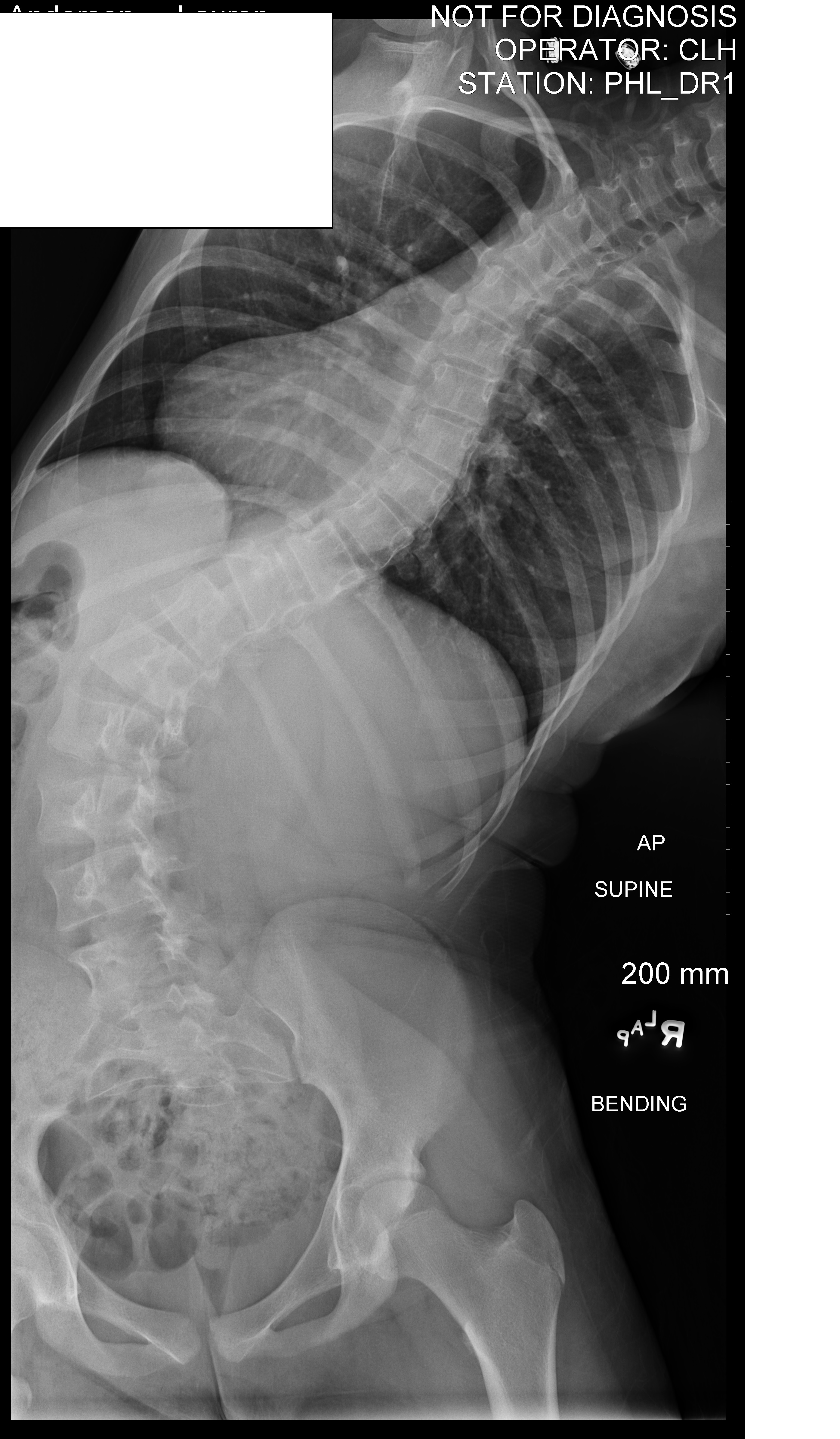 Measurements Discrepancy from x-ray images - Image Analysis - Image.sc ...