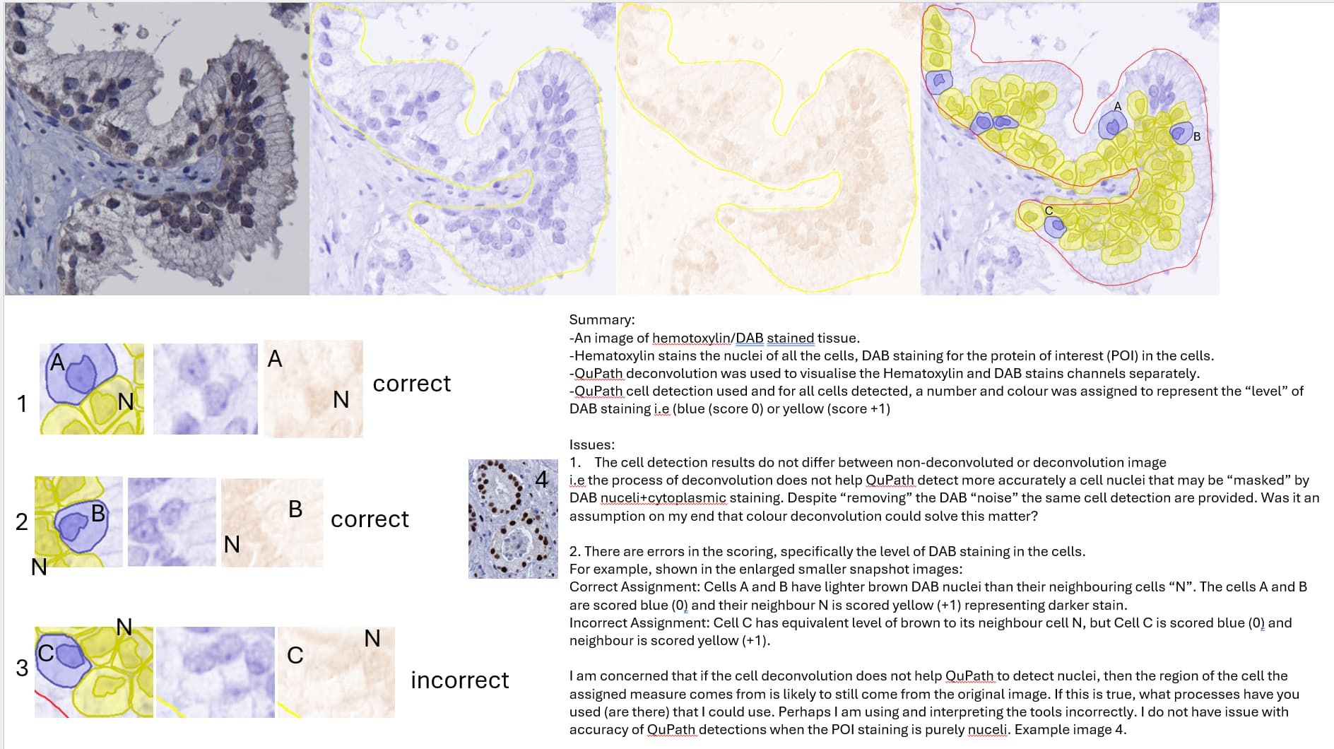 QuPath Detection and scoring of cells that have unclear nuclei due to DAB masking - Image ...