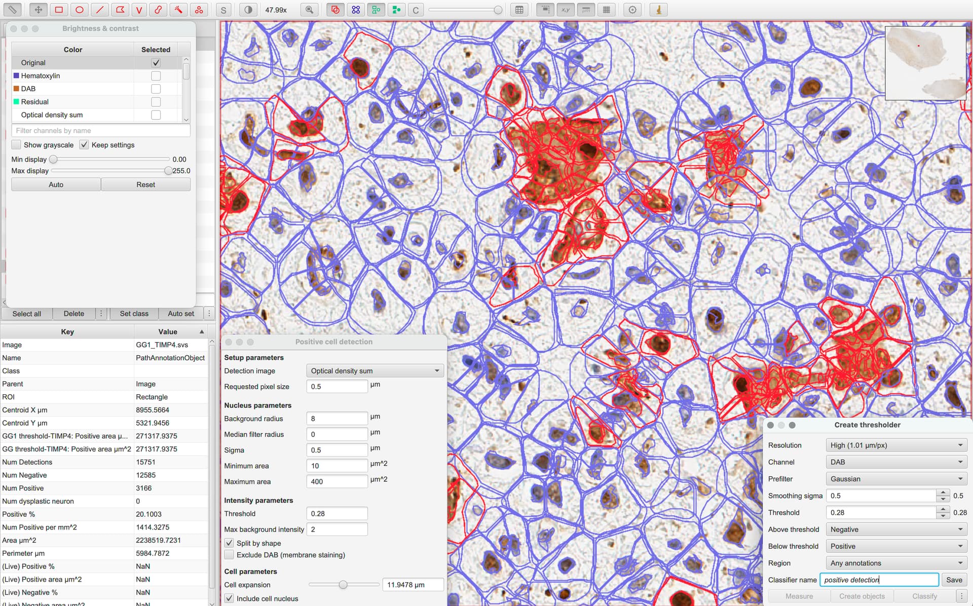 Detecting immunohistochemical stains on different size of cells and counting in Qpath - Image ...