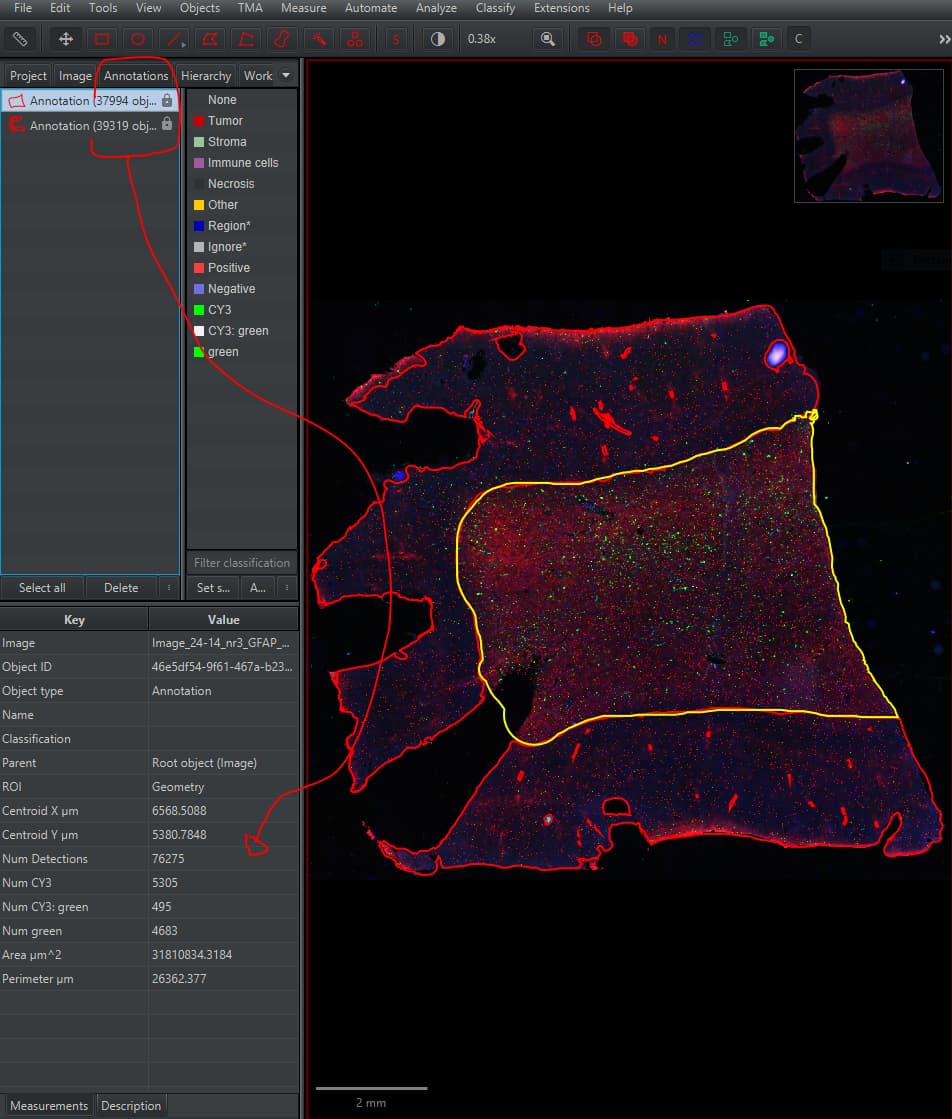 Stardist Cell detection + size filter + classification = different ... Stardist Cell detection + size filter + classification = different ...