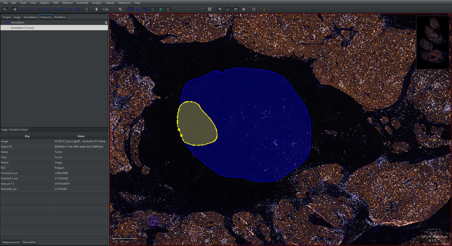 Resolving Image Hierarchy for Margin Annotation in QuPath - Usage & Issues - Image.sc Forum