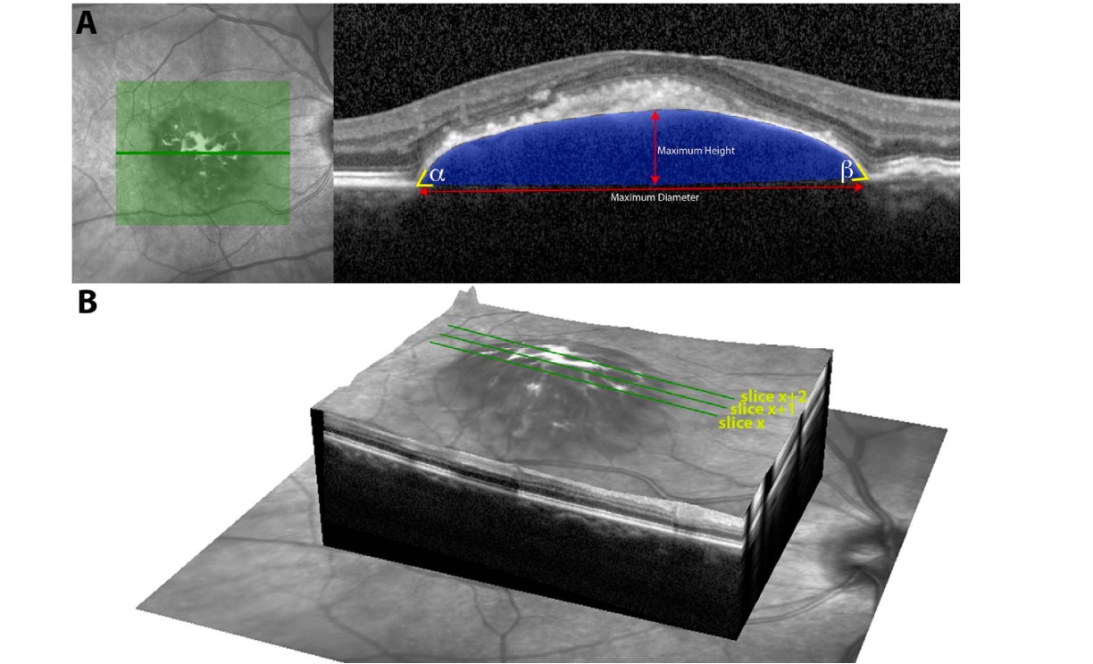 Help With OCT Retinal Image Segmentation and Volume Measurment (3D Image) - Image Analysis ...