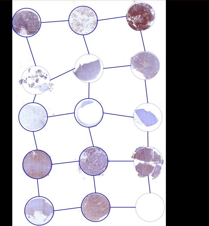 Greyed out TMA cores not included in Positive cell count - Image ...