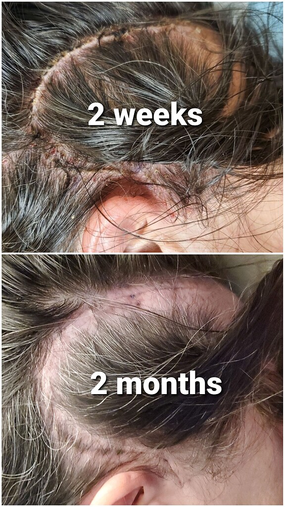 Craniotomy scar questions - General - Brain Aneurysm Support Community